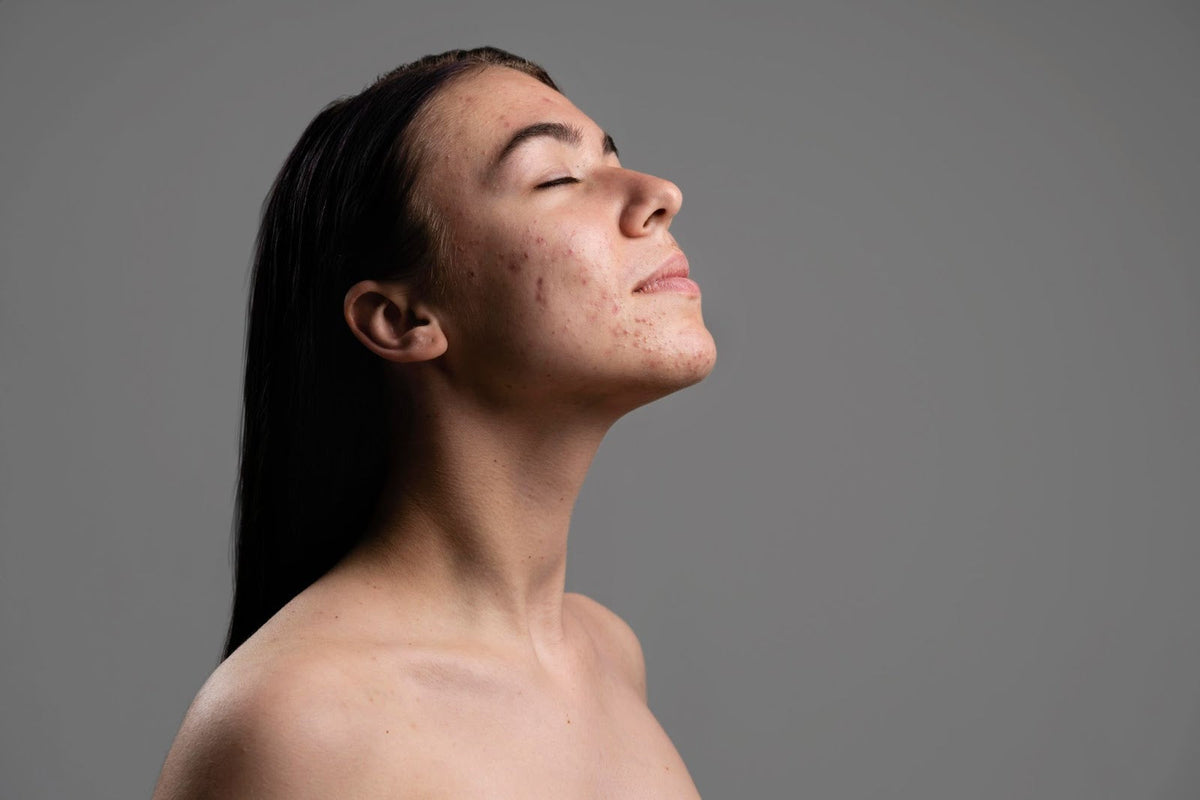 How to Get Rid of Hyperpigmentation From Acne | NutriLife